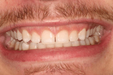 Dental Veneers Grove City - Before & After Galloway Veneers