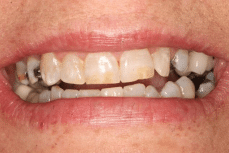 Cosmetic Smile Mock-Up in Grove City - Before & After Treatment